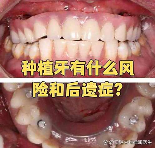 种植牙的危害