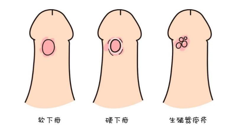男性生殖长疣图片图标