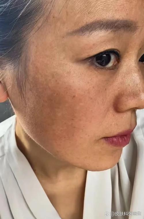 脸上黑色素沉淀怎么去除图标