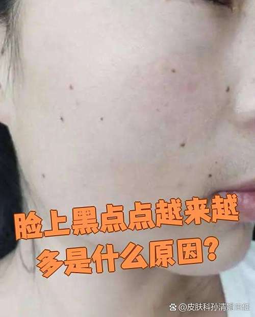 脸上出现黑点点是什么原因图标