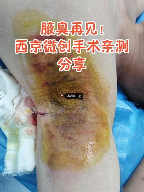 腋臭手术一般多少钱正规医院图标