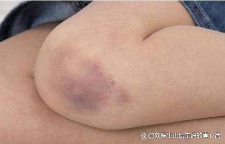 淤青第六话截图