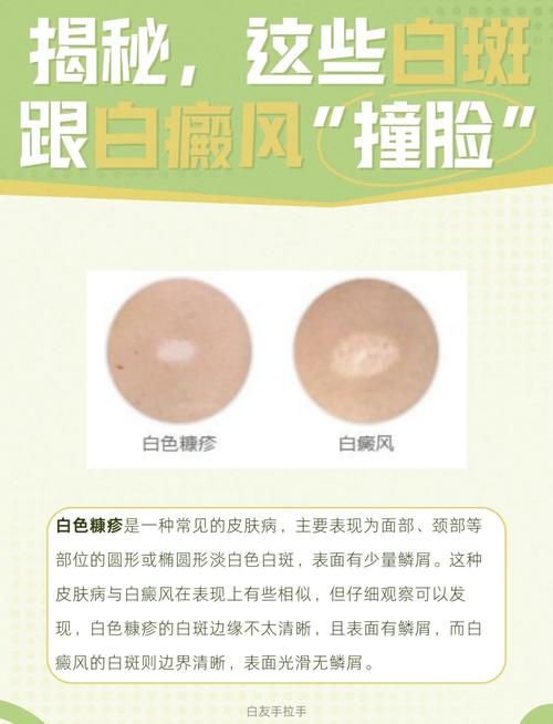 白点癫风是什么原因引起的图标
