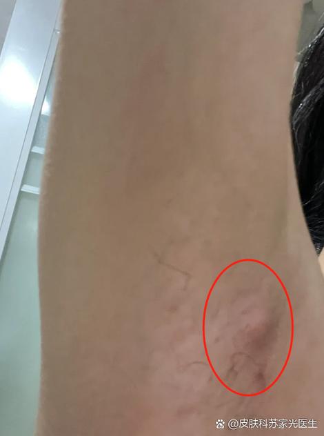 腋下长红疙瘩很痒图标