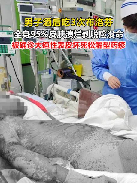 男子连吃3次布洛芬浑身溃烂图标