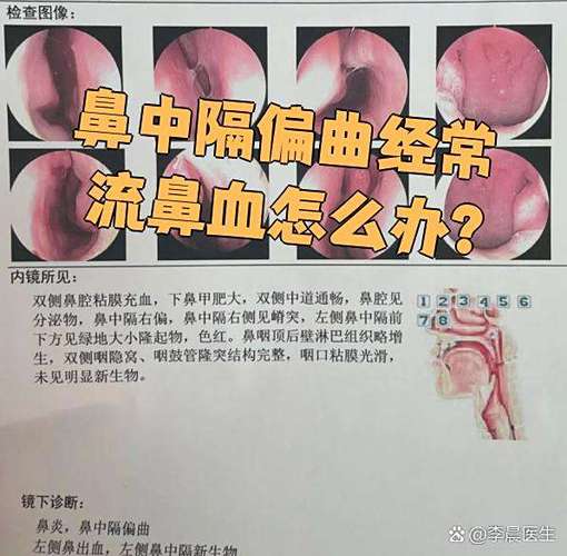 经常流鼻血是咋回事图标