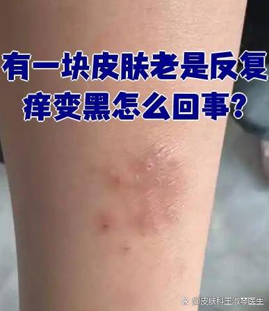 腰部痒痒越抓越痒变黑了图标