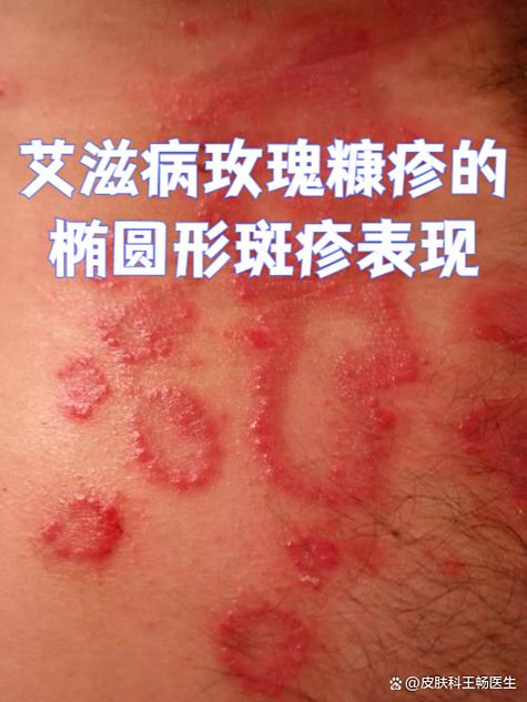皮肤一片片红色斑块是什么病图标