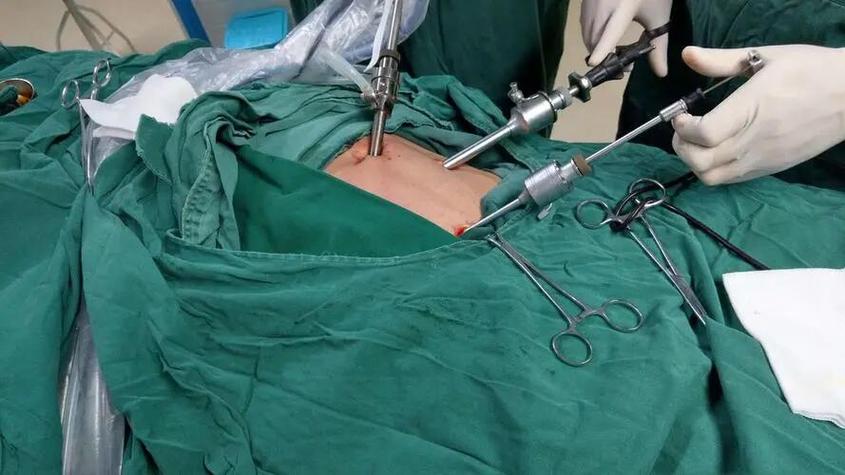 切阑尾手术视频全部过程截图