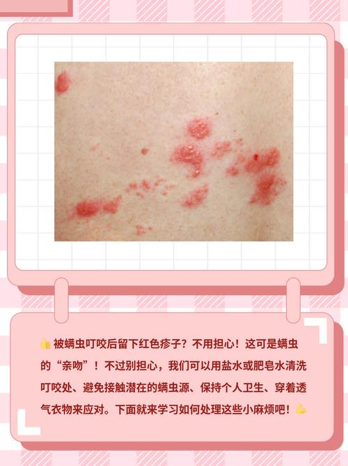 人被螨虫咬了图片图标