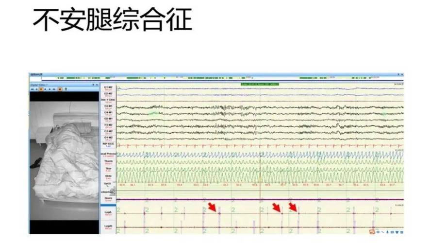 什么是多导睡眠监测截图