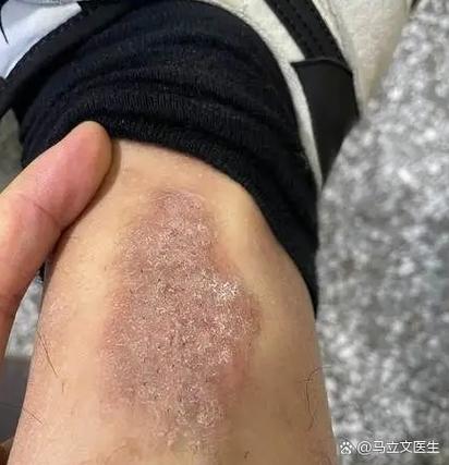 行李箱脱皮了怎么处理图标