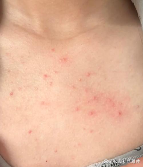 女生胸前长痘痘是什么原因图标