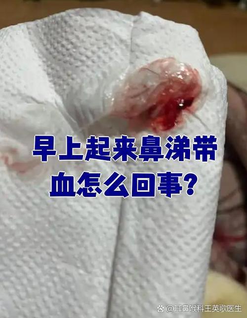 擤鼻涕擤出鼻血图标