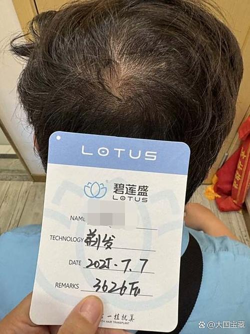 发旋能通过植发去掉吗截图