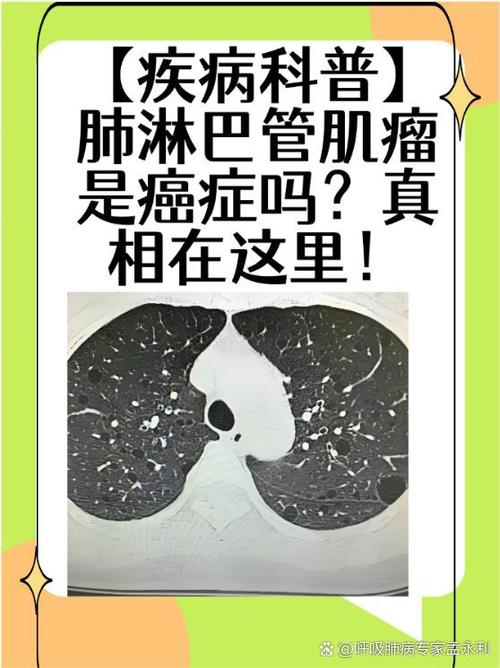 肺上有肿瘤就是癌症吗图标