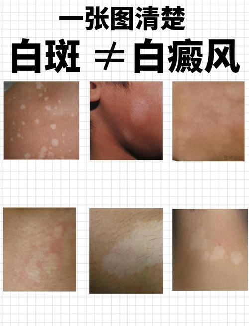 烫伤后白斑的图片图标