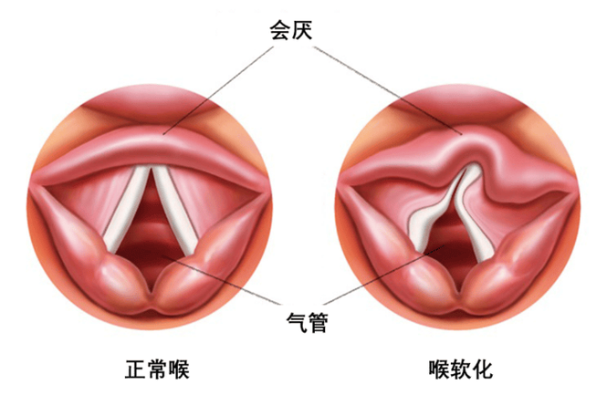 喉咙里不自主发出喉鸣图标