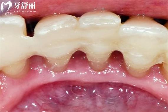 牙松动的很厉害要掉了怎么把弄掉图标