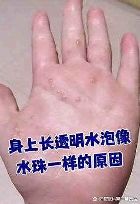 身上起透明小水珠截图