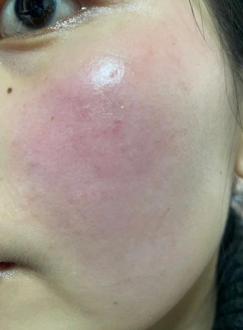 脸部角质层薄怎么修复截图
