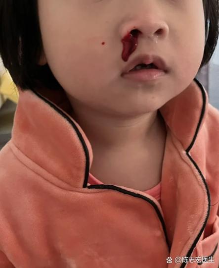 小孩容易流鼻血图标