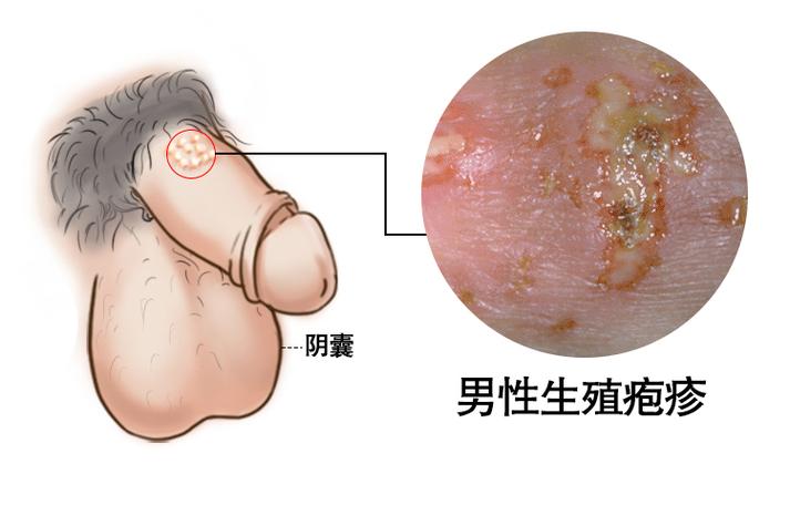 生殖疱疹2型会转阴吗截图