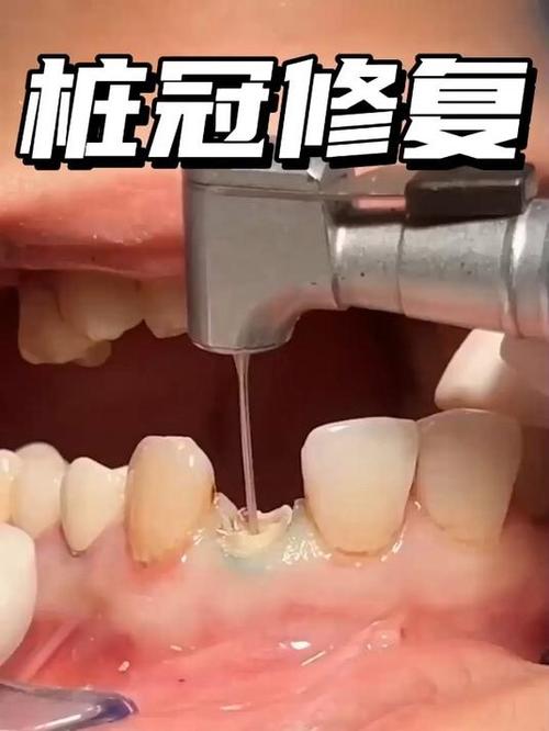 补一个门牙多少钱图标