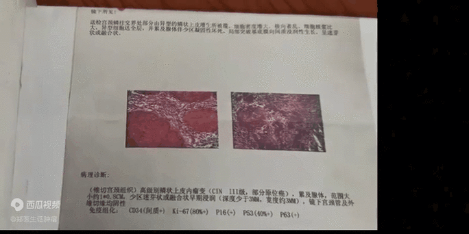 术中病理为良性准确率截图