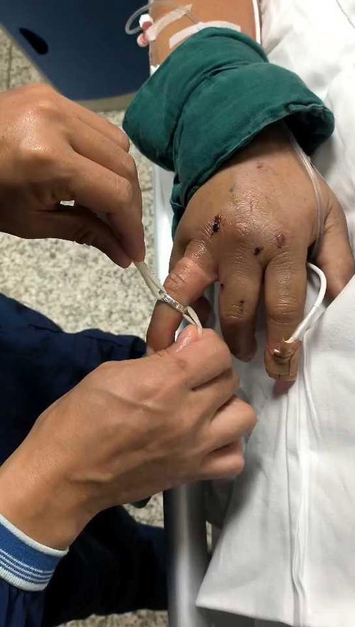 手上的戒指取不下来怎么办