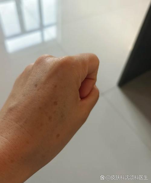 手上长棕色的类似于痣的小点
