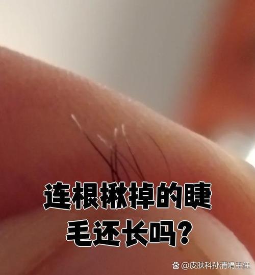 反复拔毛还会长出来吗图标