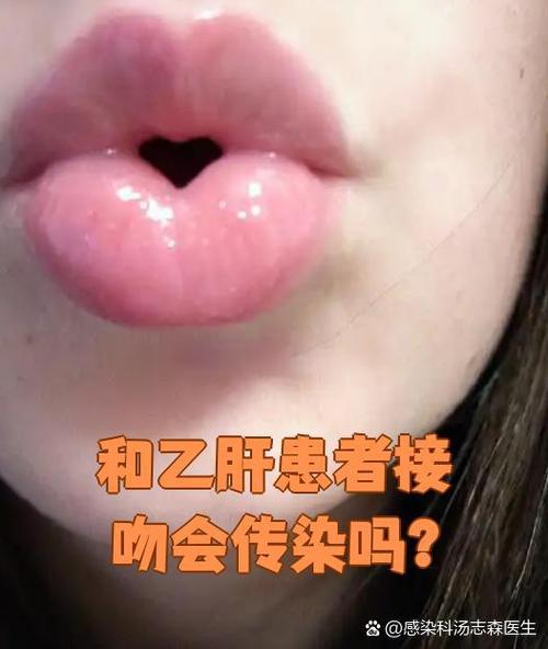 接吻会传染乙肝病毒吗图标