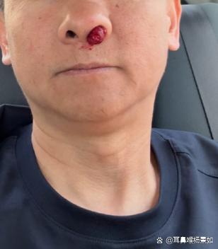 鼻子流鼻血是什么原因图标