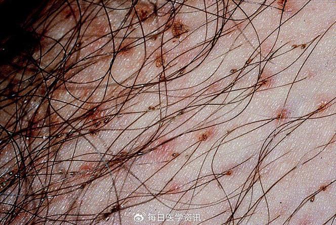 阴虱的治疗方法图标