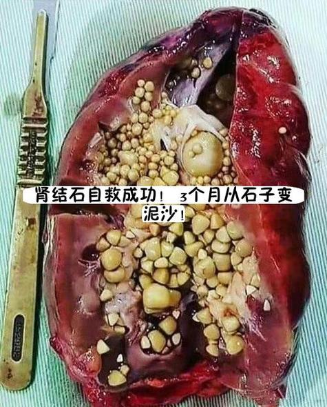 肾结石碎石的副作用