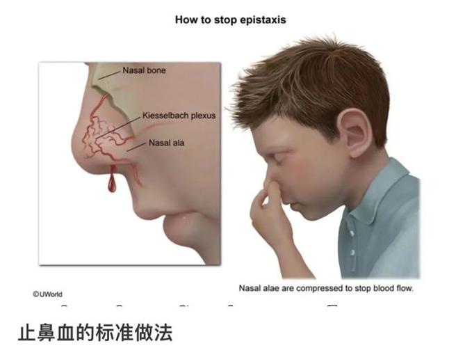 流鼻血填塞去医院取出来挂什么科图标