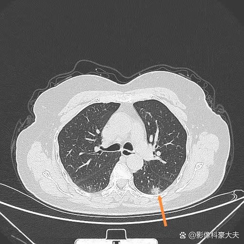 怎么把医院CT拷出来截图