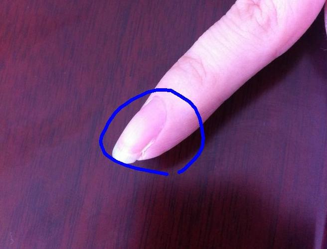 指甲出现紫色竖纹怎么回事截图