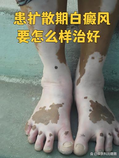 得白癜风是什么原因引起的截图