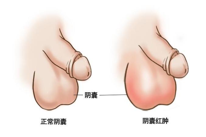男性睾丸正常图片缩略图