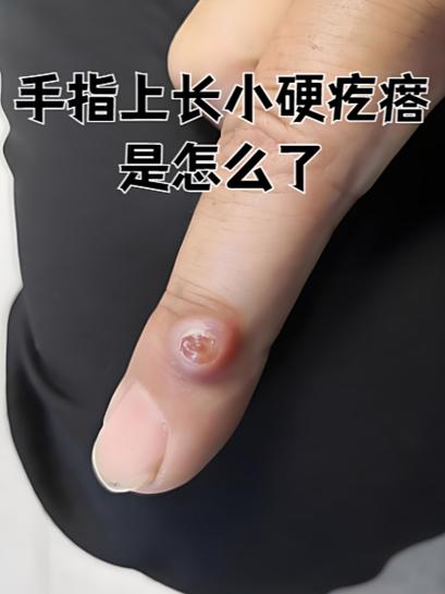 牛牛皮上长个硬硬的小疙瘩图标