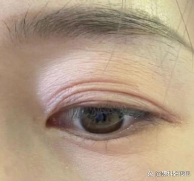 眼部皮肤松弛怎么处理图标