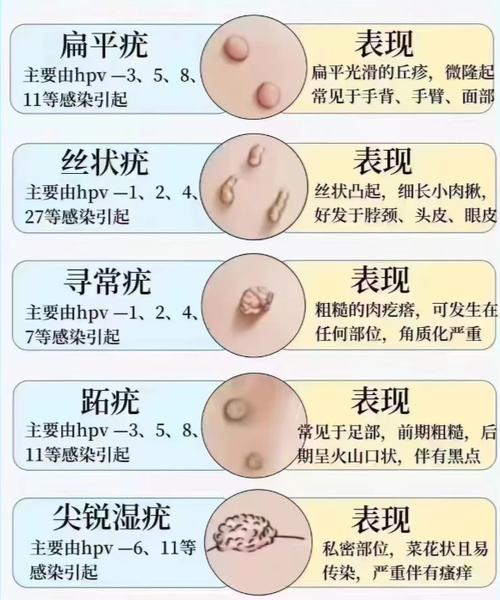 hpv疣是什么样子图片图标