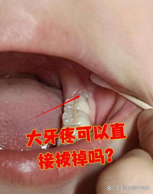 大牙松动疼痛该拔掉吗
