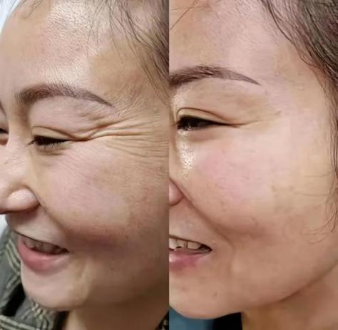 去脸部皱纹图标