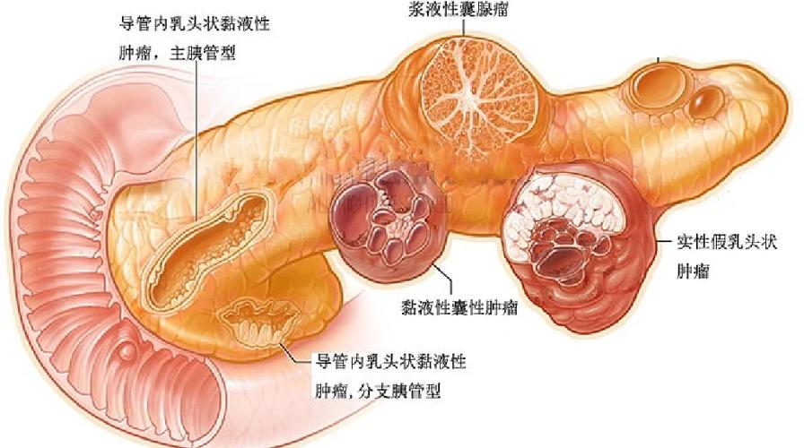 胰腺肿瘤图标