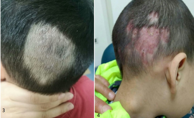 中医认为孩子拔毛癖是什么病图标