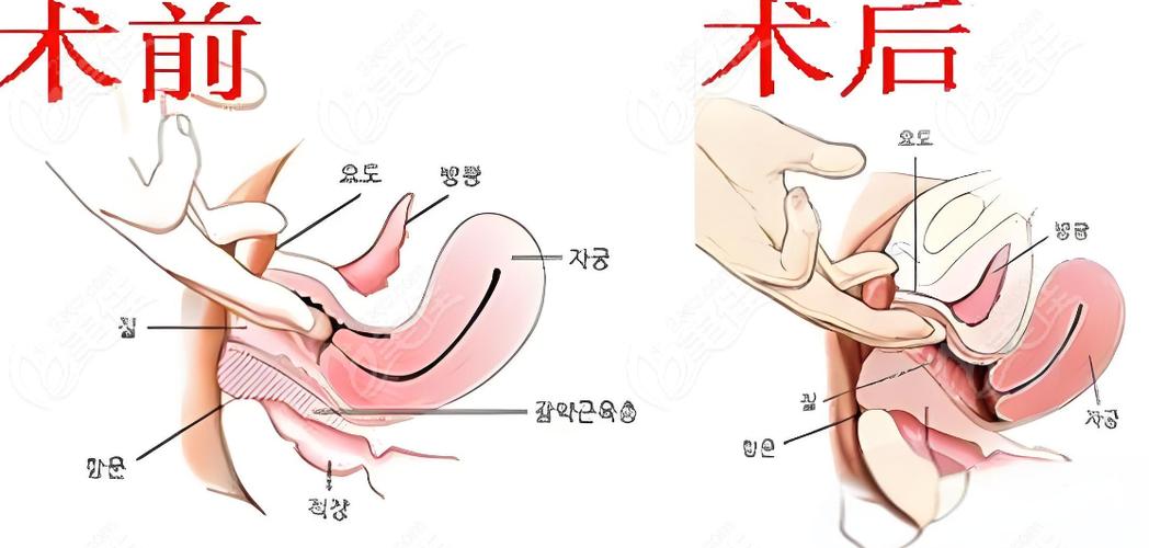 妇科紧缩手术值得做吗图标