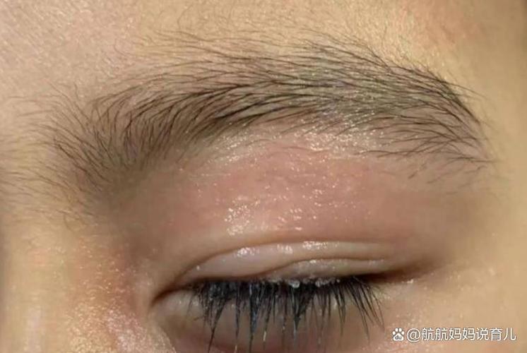 眼睛不小心沾到502胶图标